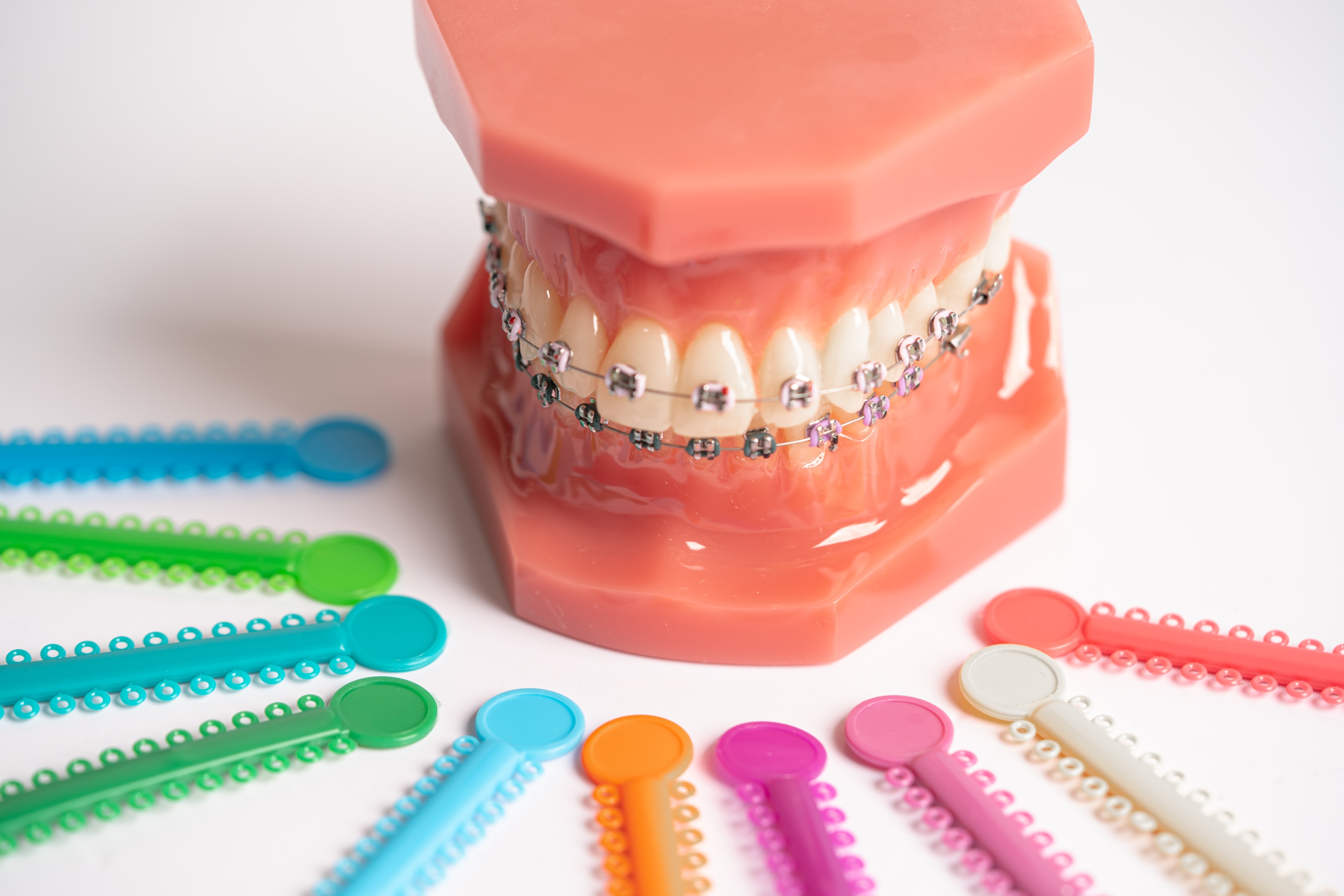 What are Partial Braces? - Benefits, Treatment, and Process