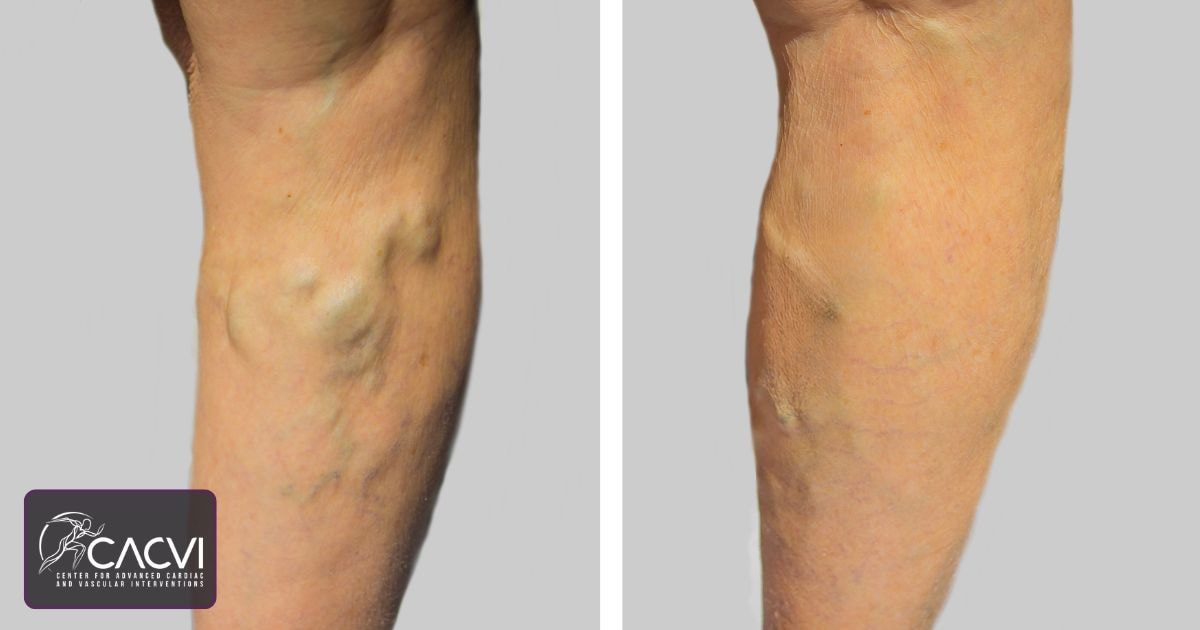 Varicose Veins Before and After Results | How Treatment Works