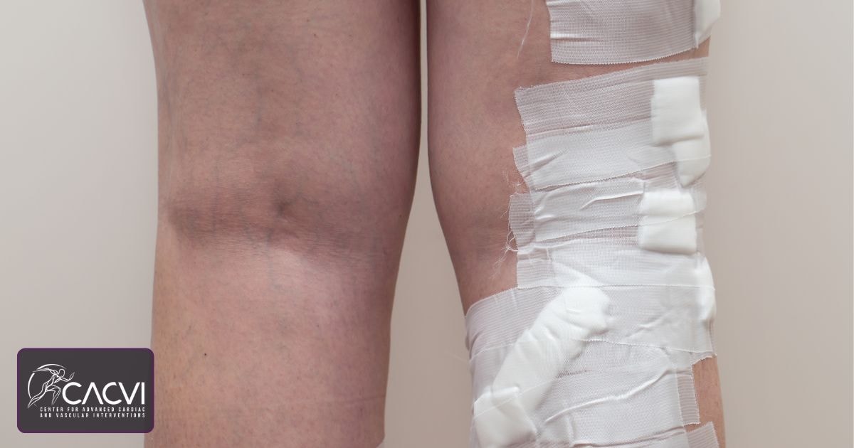 Sclerotherapy After 1 Week: How to Ensure a Smooth Recovery