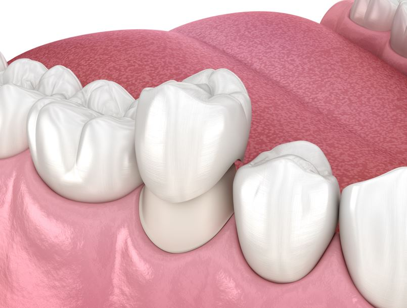 Dental Crown Comprehensive Guide | 360 Family Dental