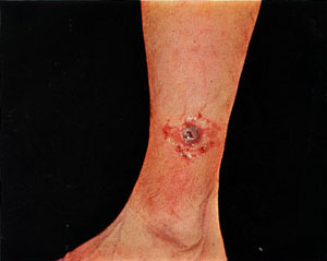 Flea-borne Diseases: A Comprehensive Guide