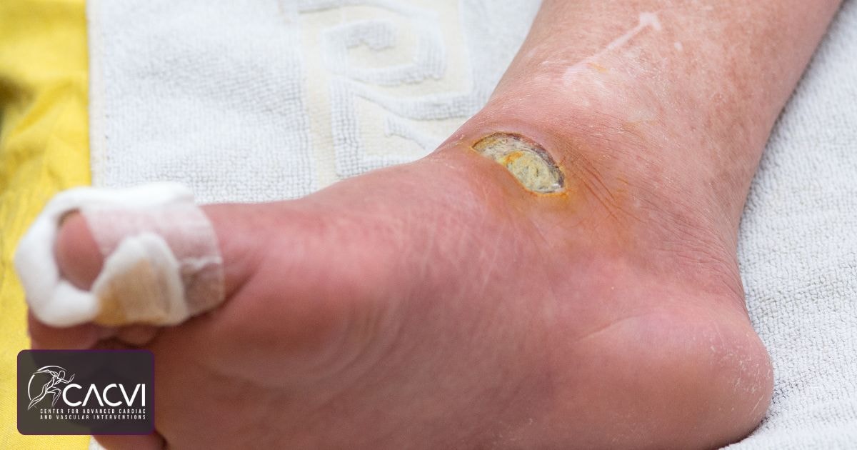 Leg Ulcer Pictures (2025) | CACVI