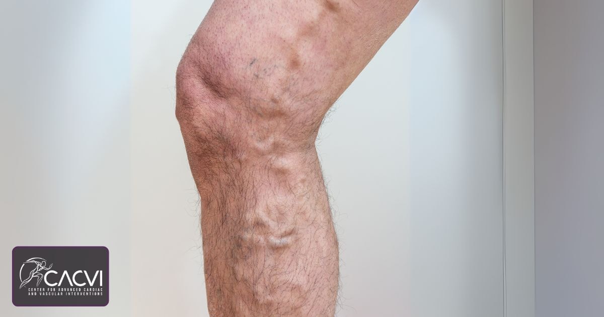 What Is a Vascular Doctor and Why You Might Need One?