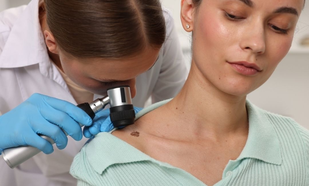 How Do You Get Rid of Skin Moles | Effective Methods