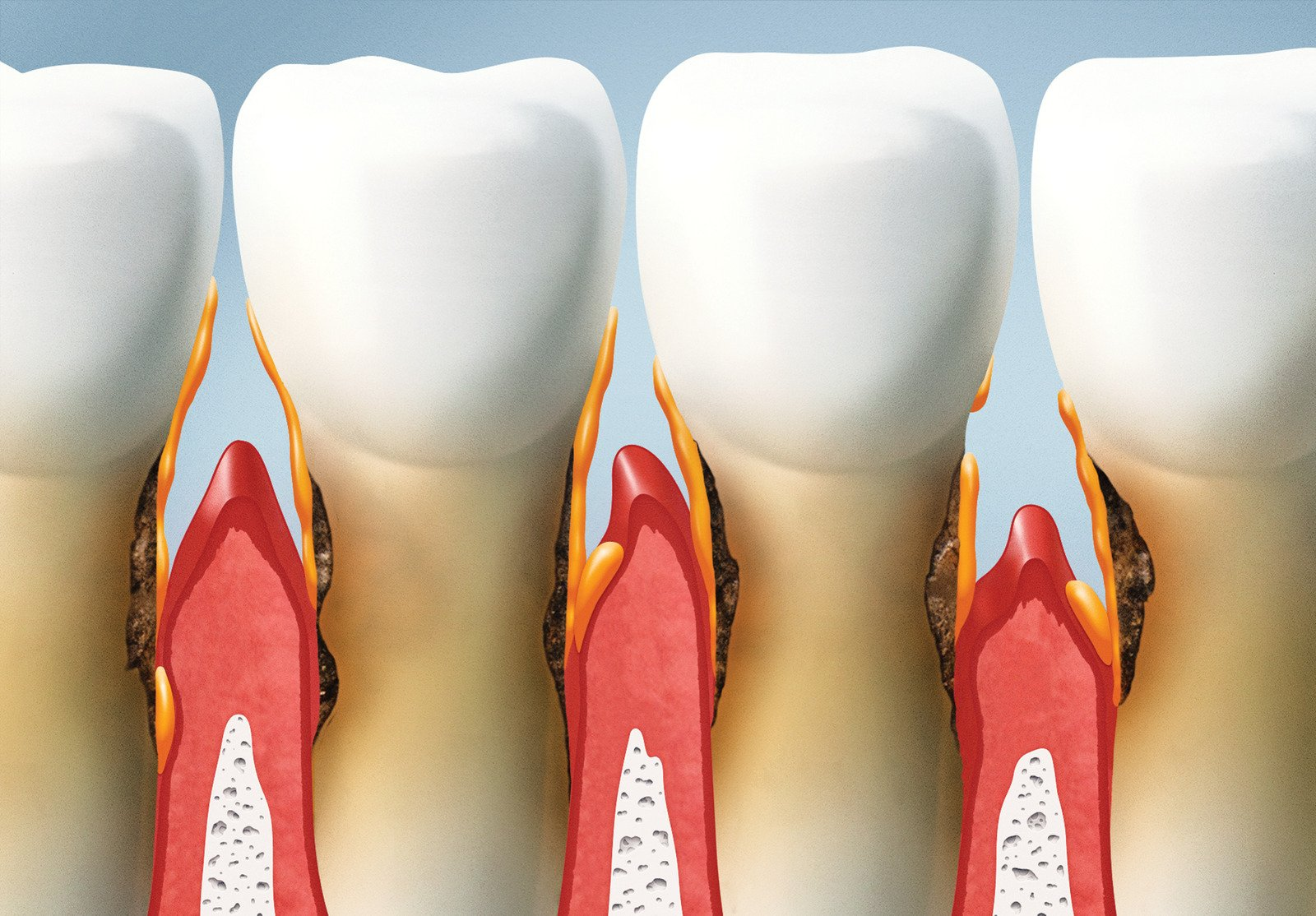Understanding Periodontal Disease Stages - Cedar Creek Dental