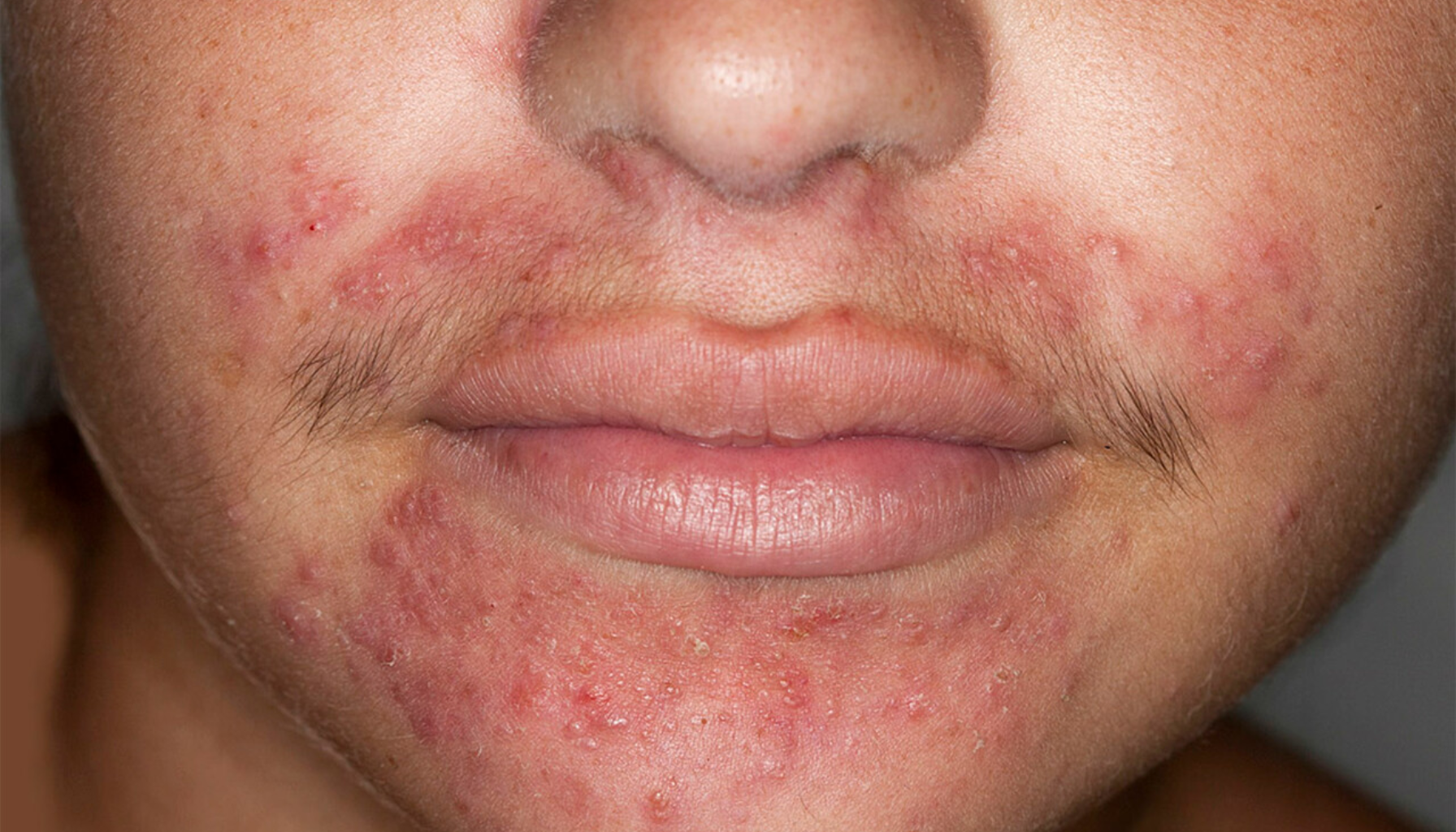 Periorifisiell Dermatitt: Hudens Utslett