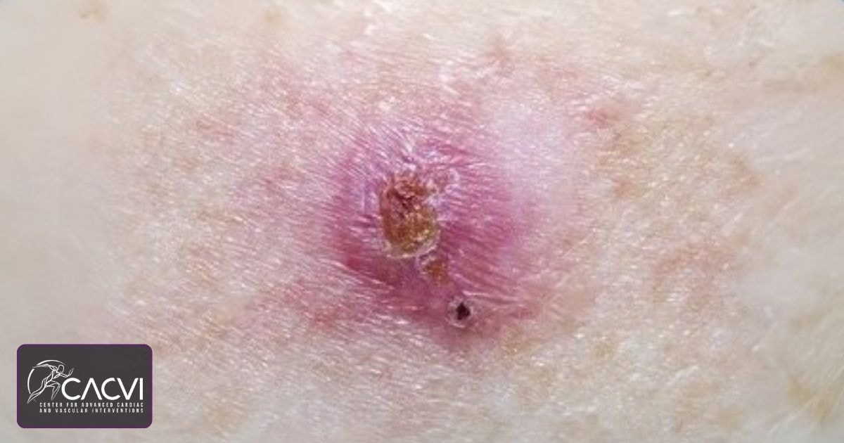 Leg Ulcer Pictures (2025) | CACVI