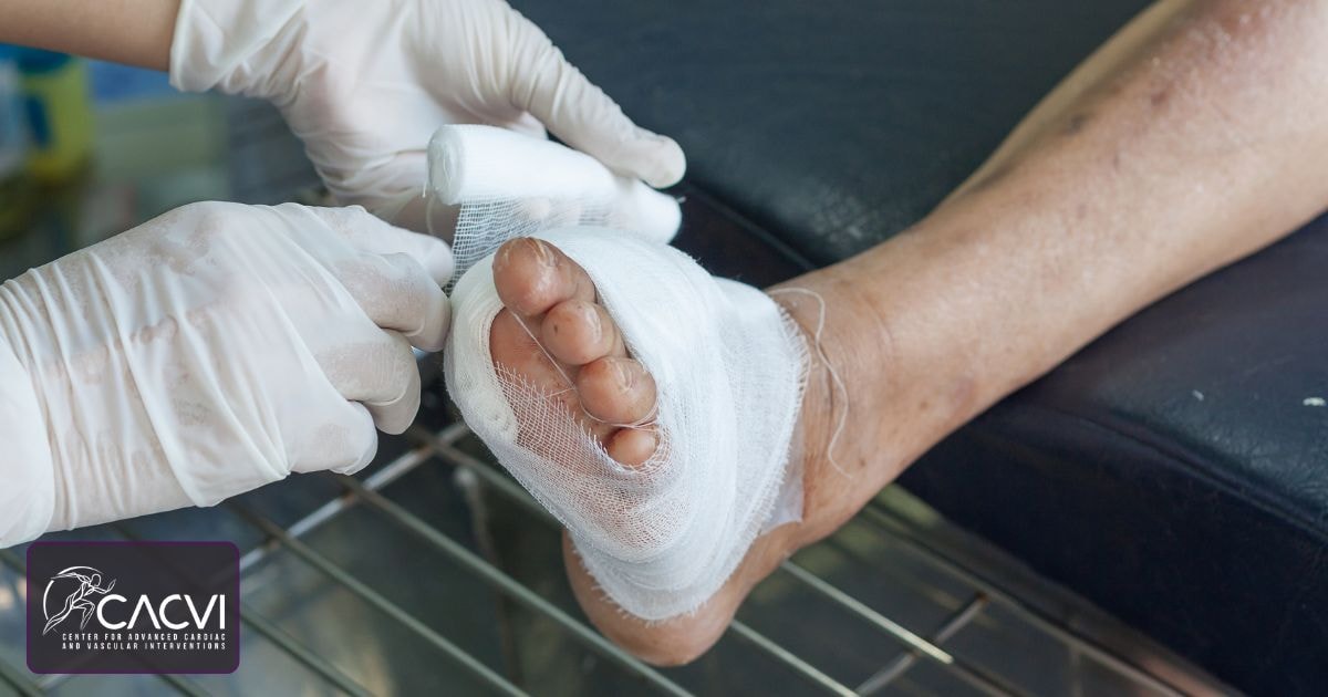 Leg Ulcer Pictures (2025) | CACVI