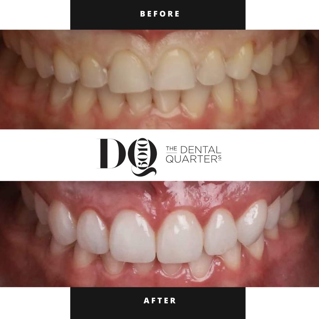 Summer Teeth: Top Solutions for a Brighter Smile - Dental Quarters