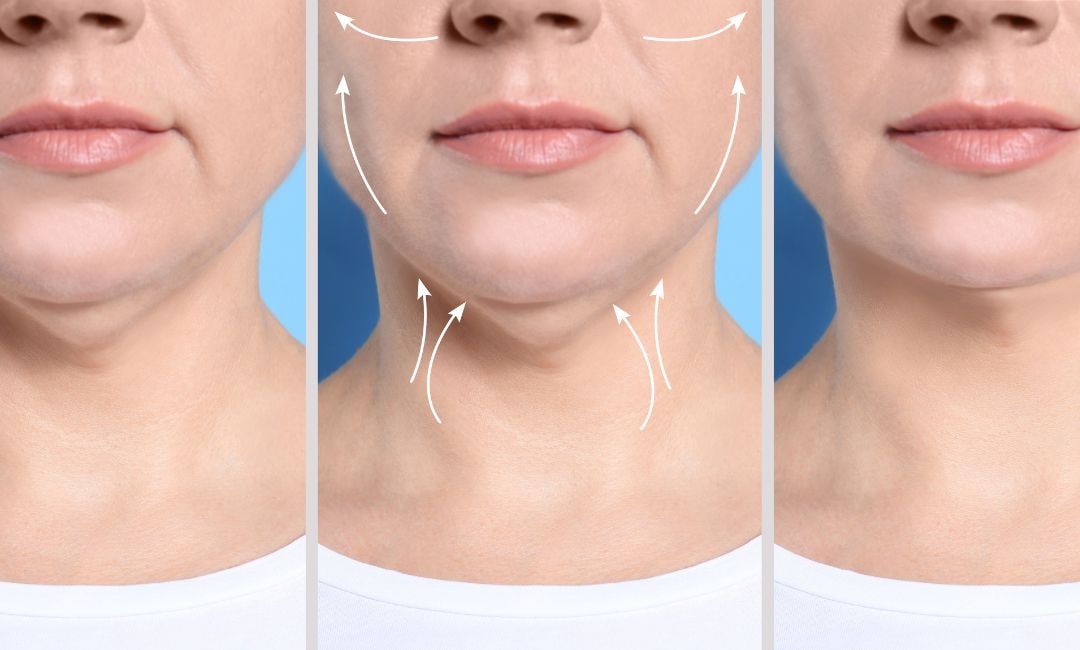 Chin Botox | Benefits and Considerations