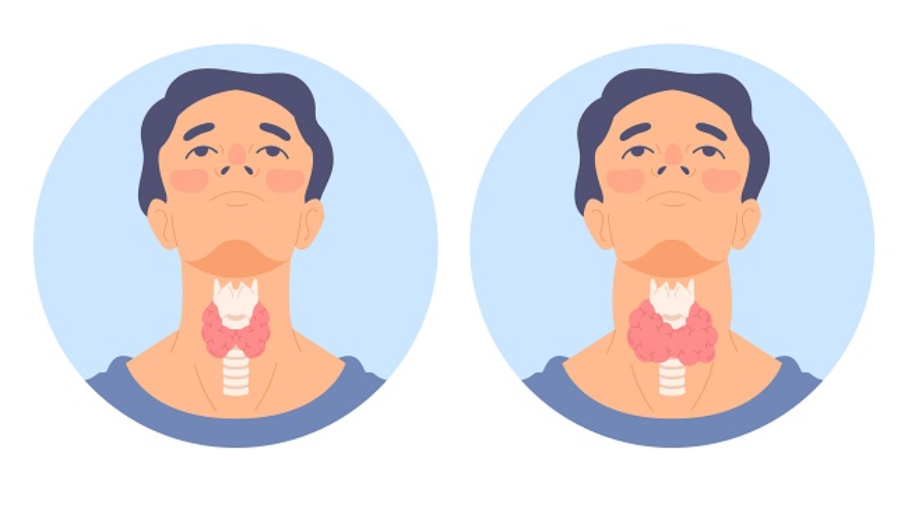 Anti-TPO Antistoffer: Hva De Betyr For Skjoldbruskkjertel