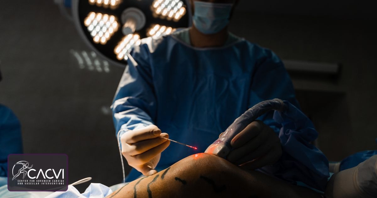 Varicose Vein Surgery Recovery | How to Heal Faster