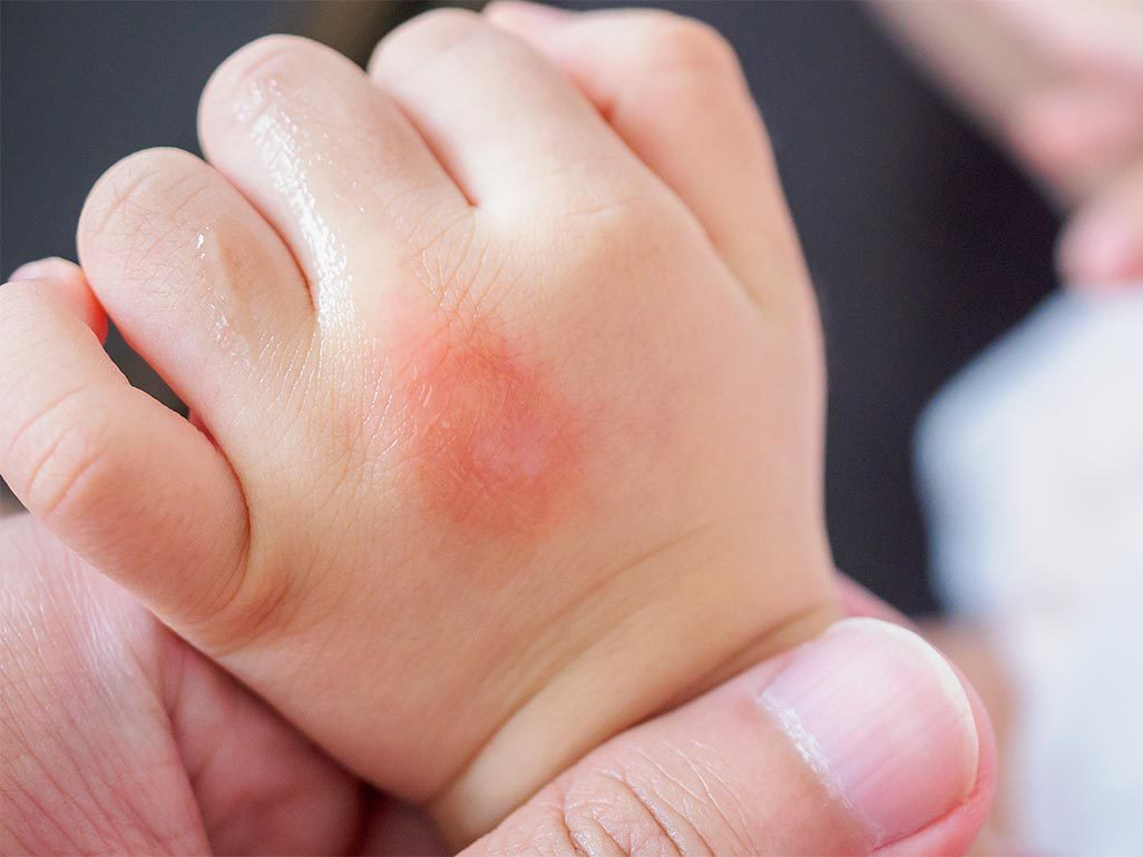 Scorpion Stings: Appearance and Symptoms Decoded