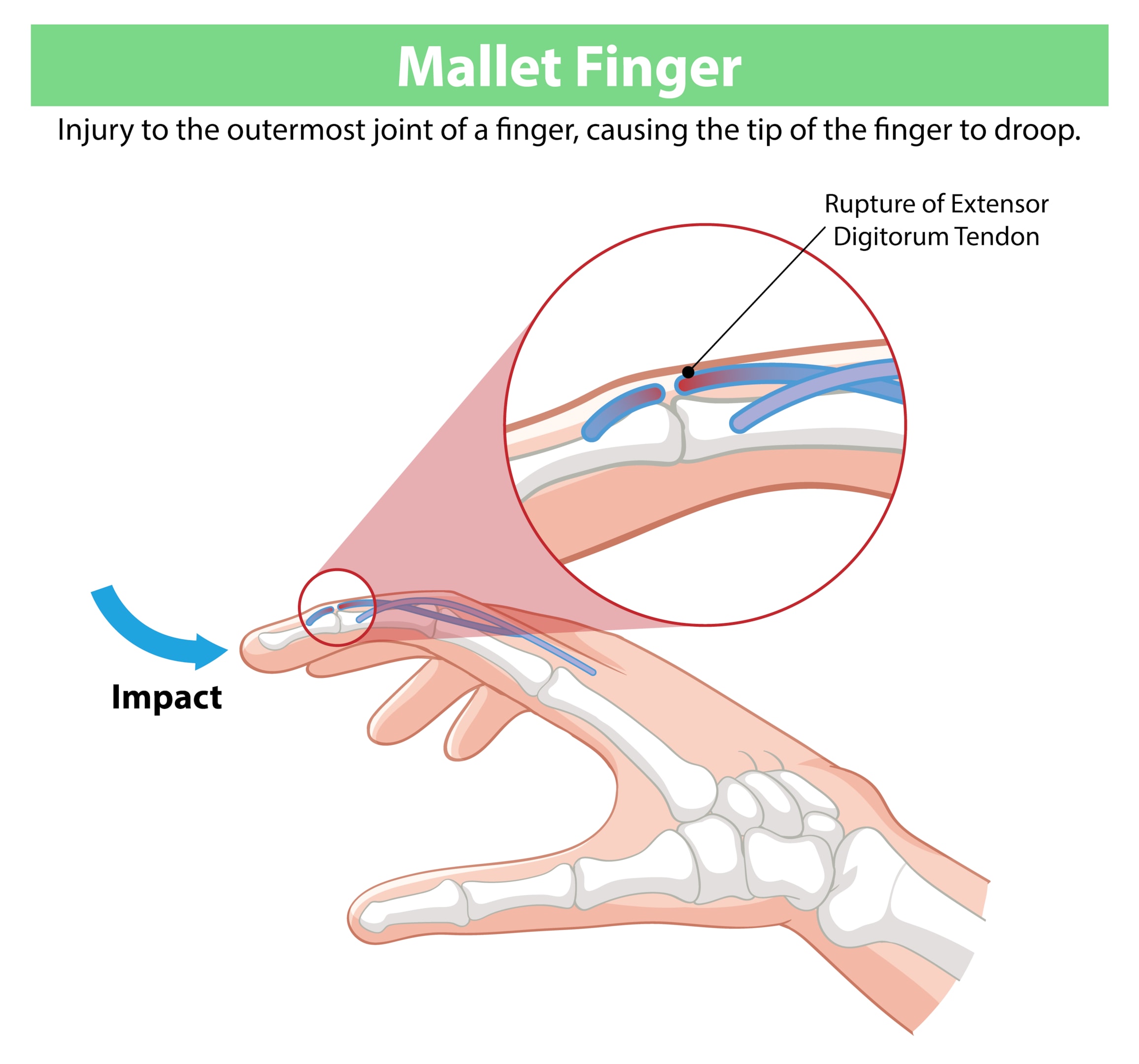 The Best Mallet Finger Splints for Effective Recovery and Support ...