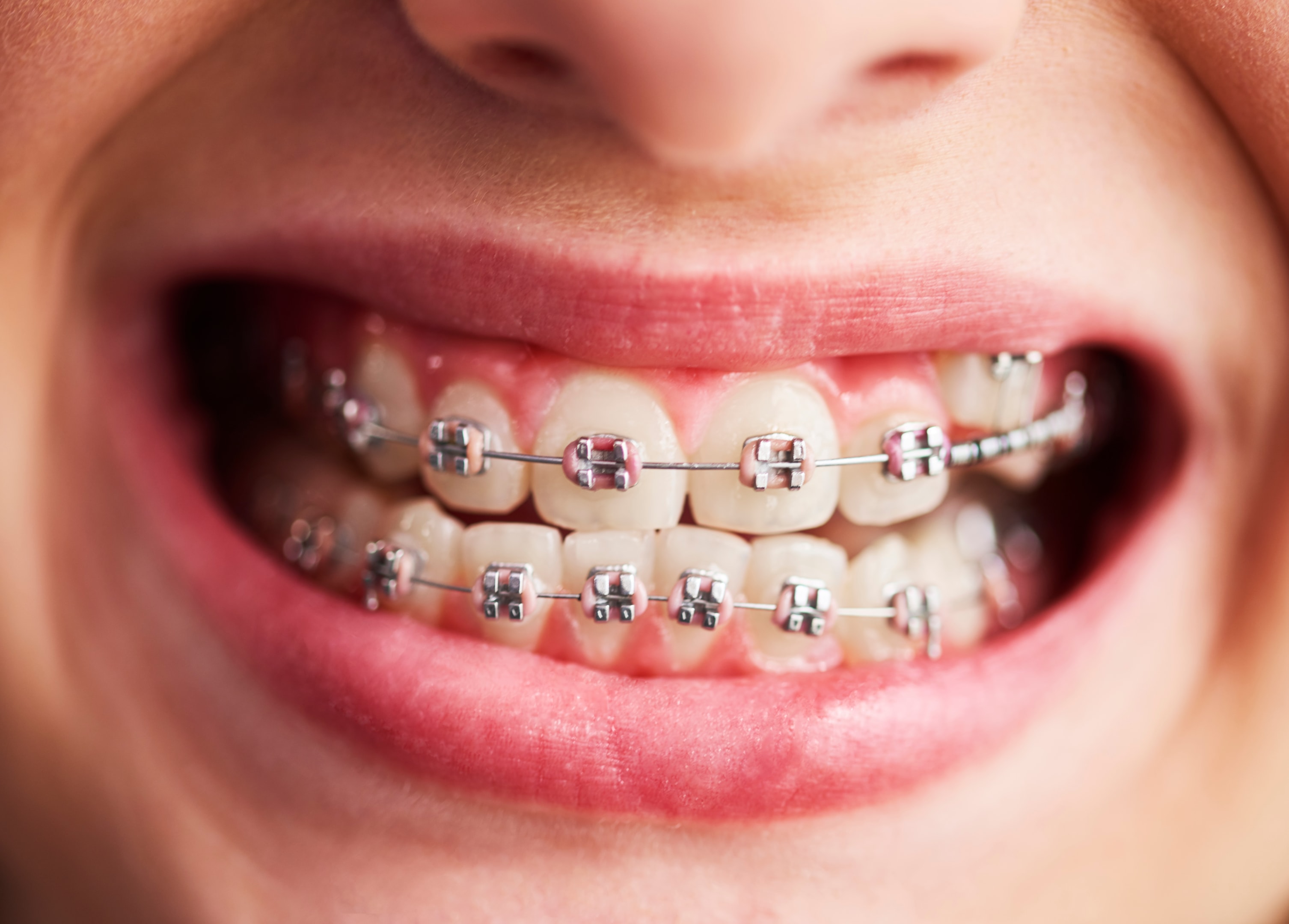Student Braces Singapore: 4 Types, Benefits, and Costs