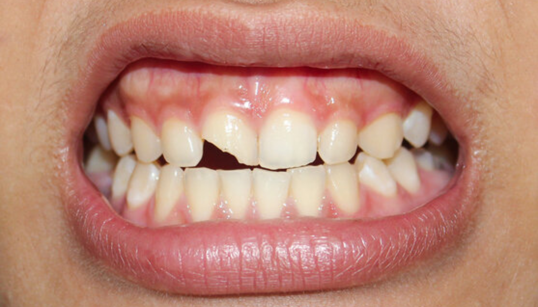 Fortenner – Betydning, Funksjon Og Behandling Av Skader