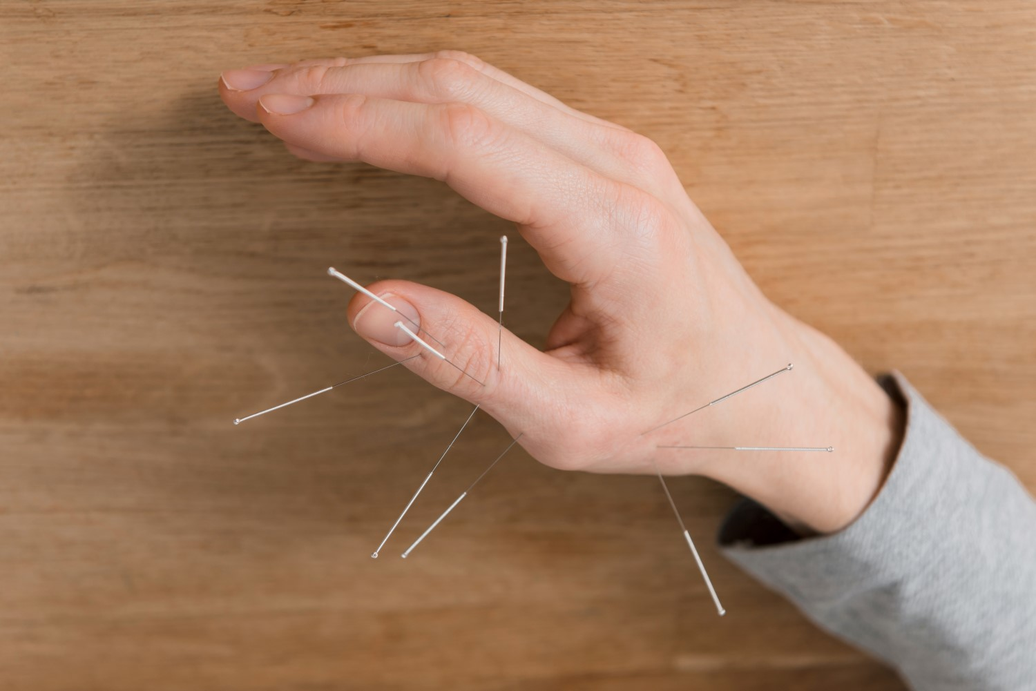 Dry Needling VS Acupuncture: What are the differences? Dry Needling VS Acupuncture: What are the differences?