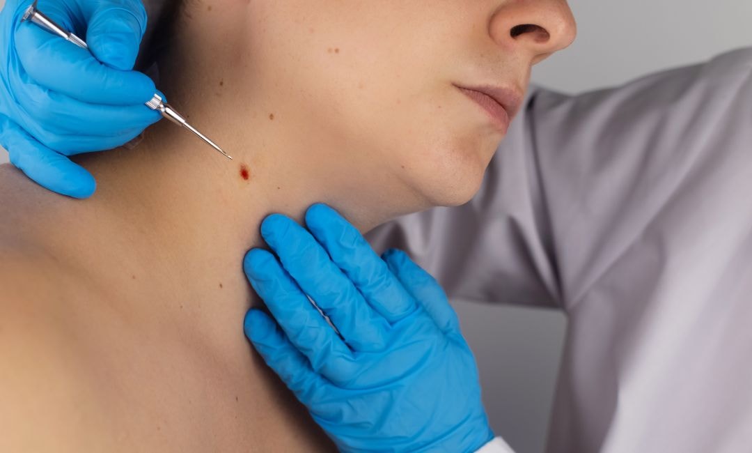 Mohs Surgery Cost | What to Expect and Factors Involved
