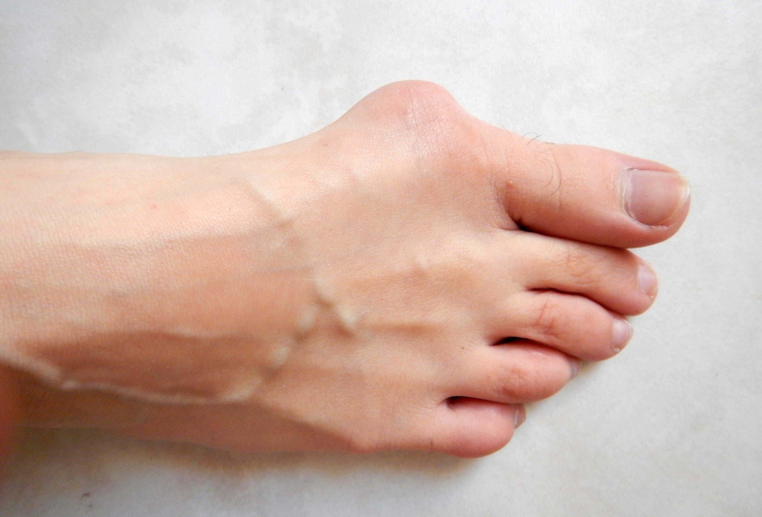 Relief Strategies for Flat Foot Bunion: Pain Management and Prevention