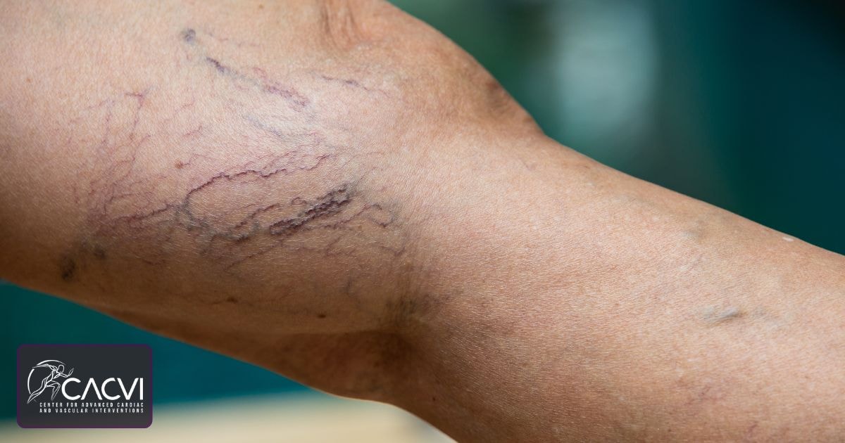 Varicose Veins Treatment Cost Find The Best Affordable Options