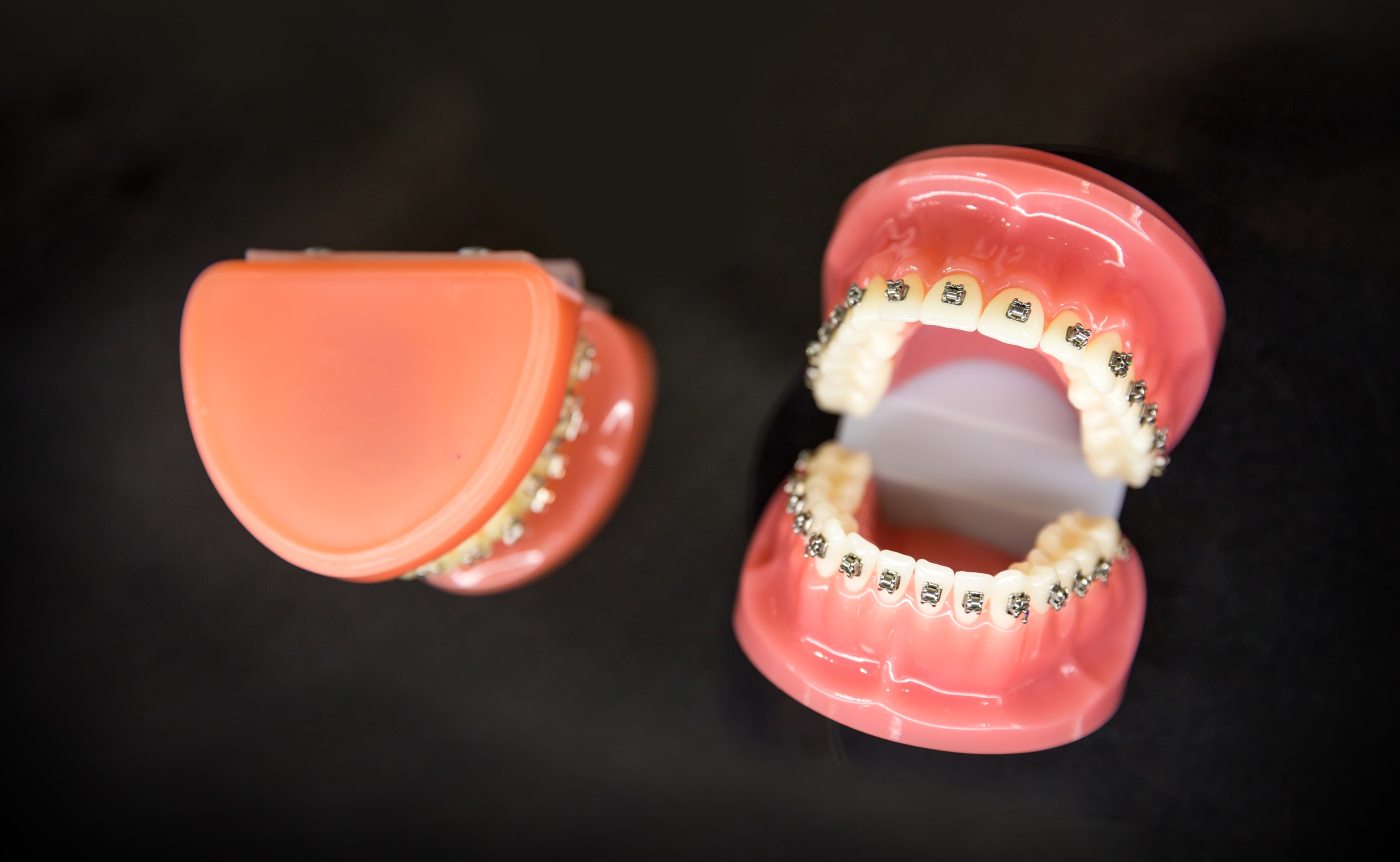 What are Partial Braces? - Benefits, Treatment, and Process