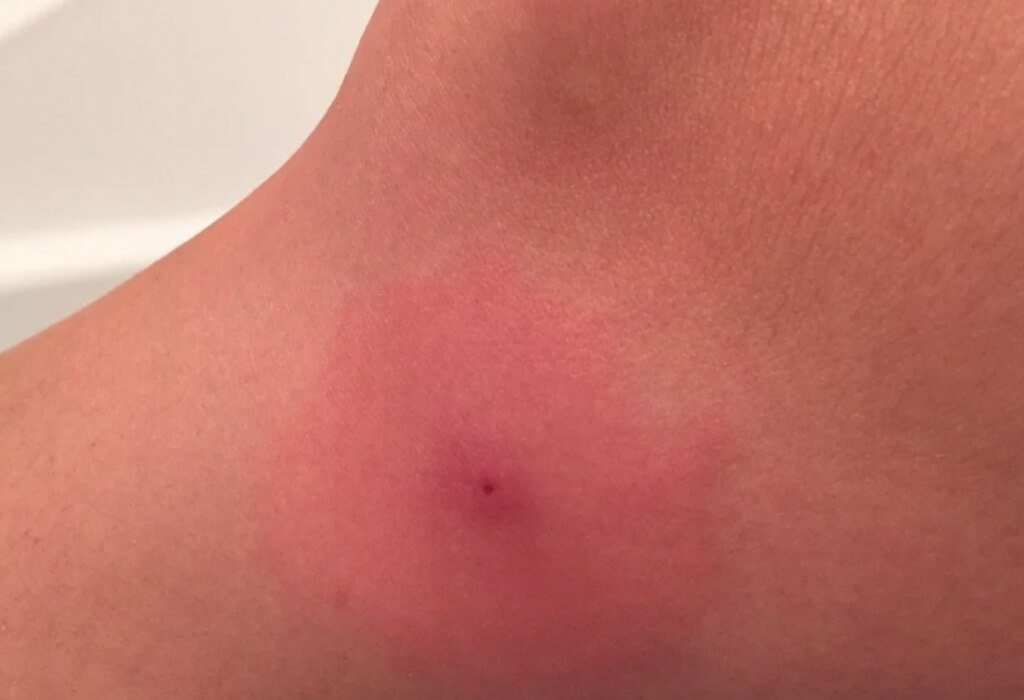 Zebra Spiders: Debunking the Poisonous Myth