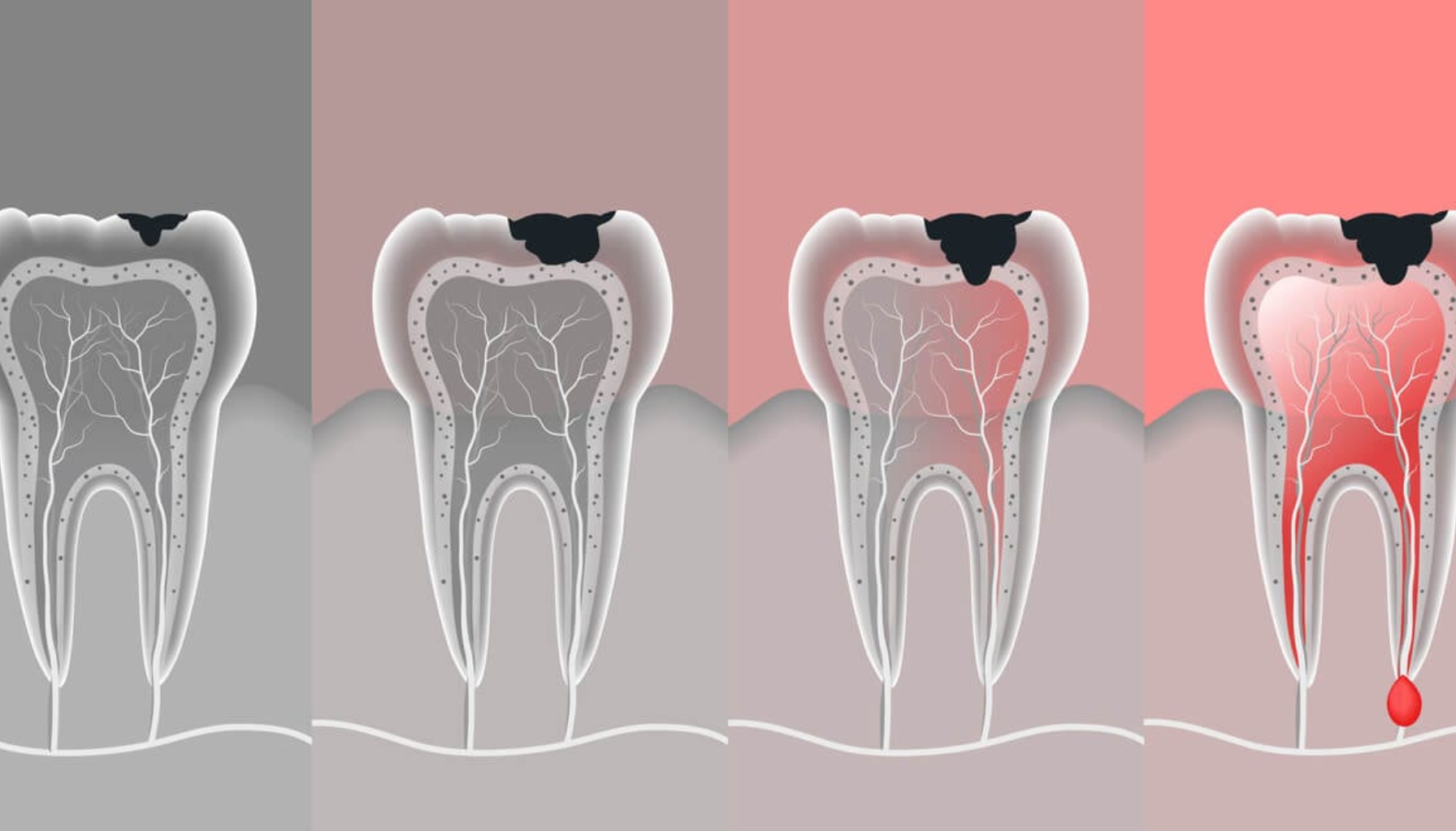 Slik Forebygger Du Mandelsteiner | Godtanna Løten Tannlegesenter