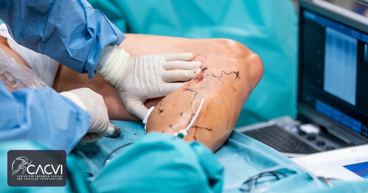 Before and After Vascular Surgery | What to Expect