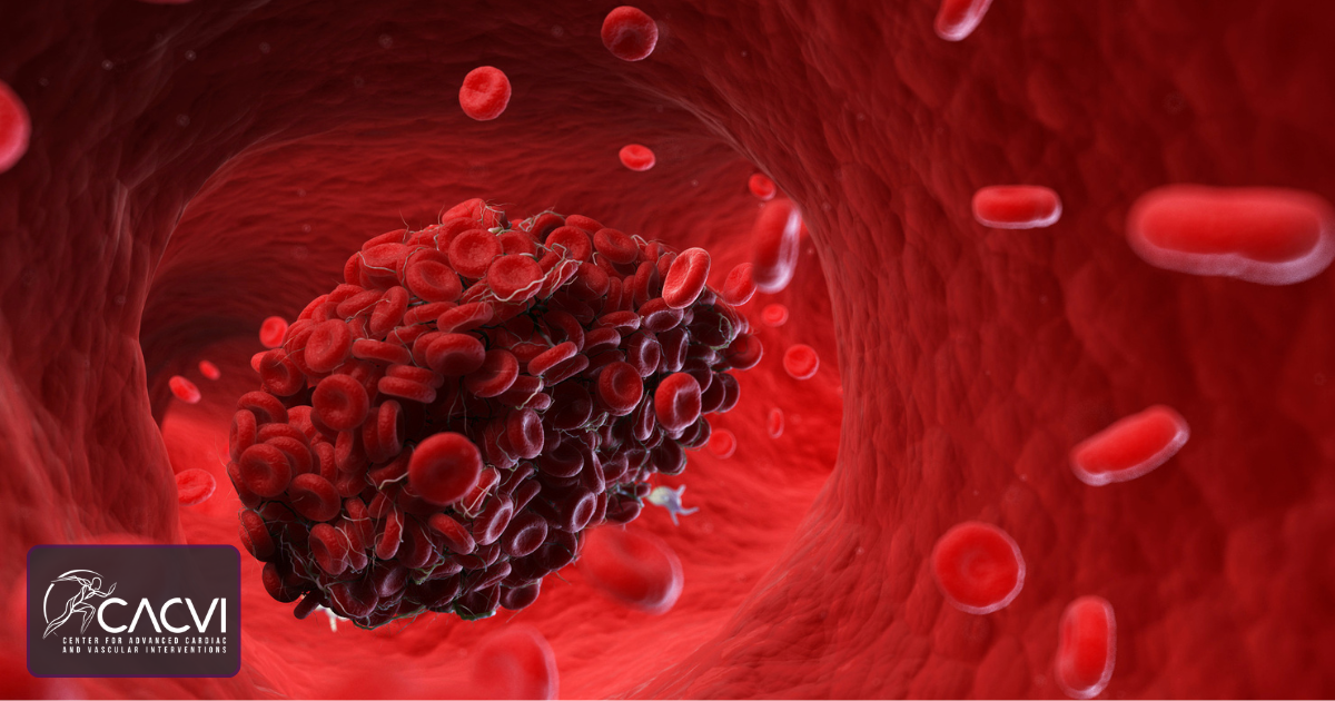 Can You Massage a Blood Clot Out? Risks & Safety