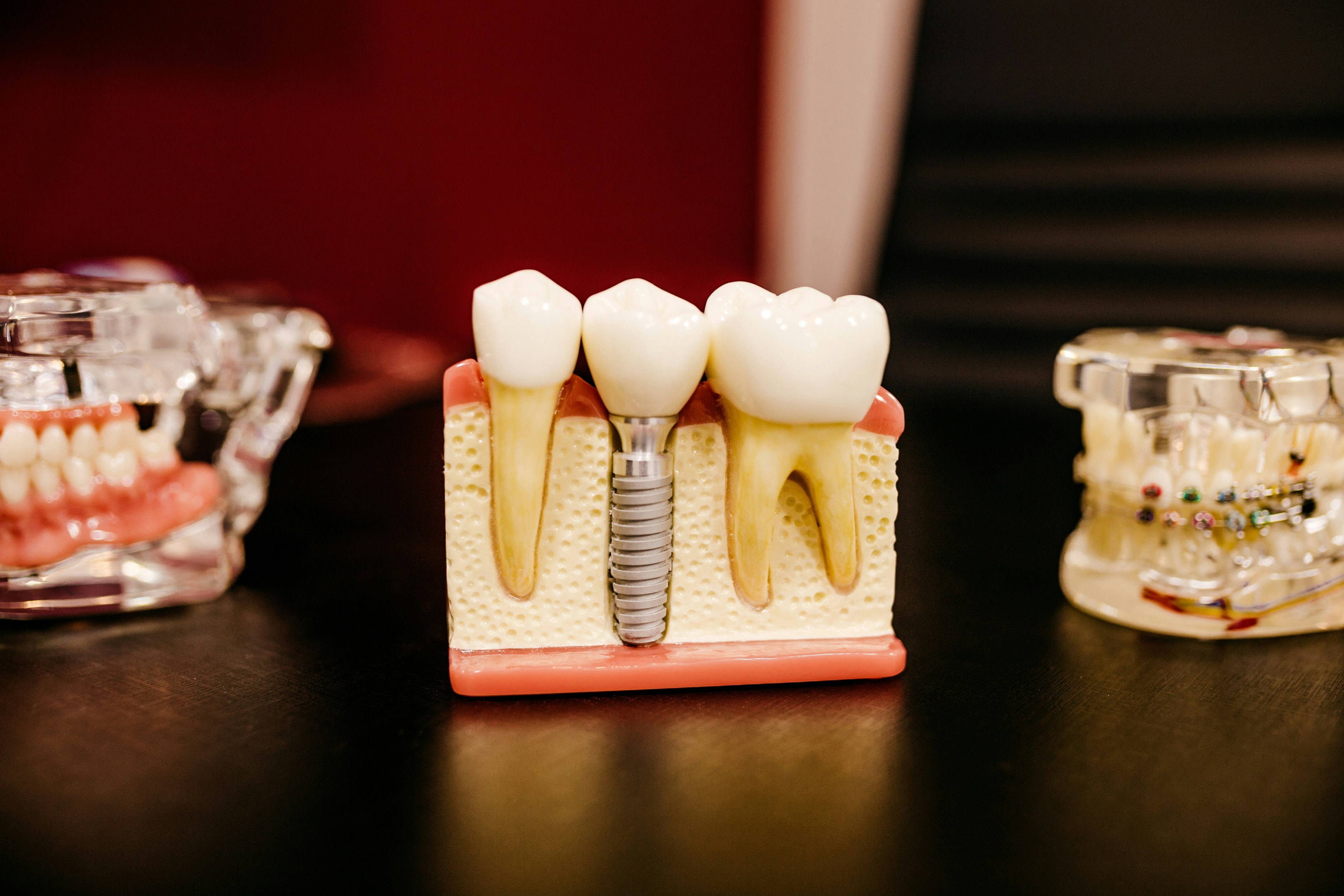 Missing teeth: what are the replacement options? - Dental Quarters