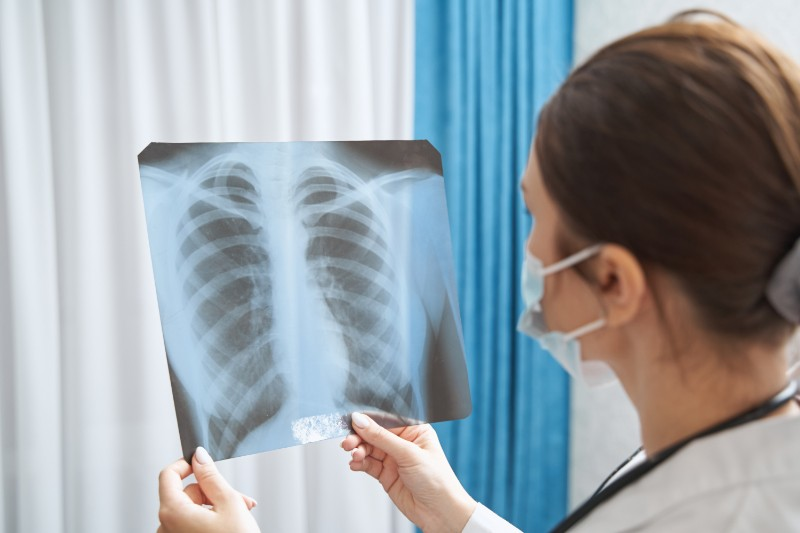 What to know about costochondritis