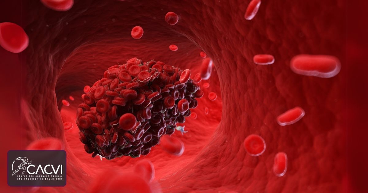 Can Varicose Veins Lead to Blood Clots?