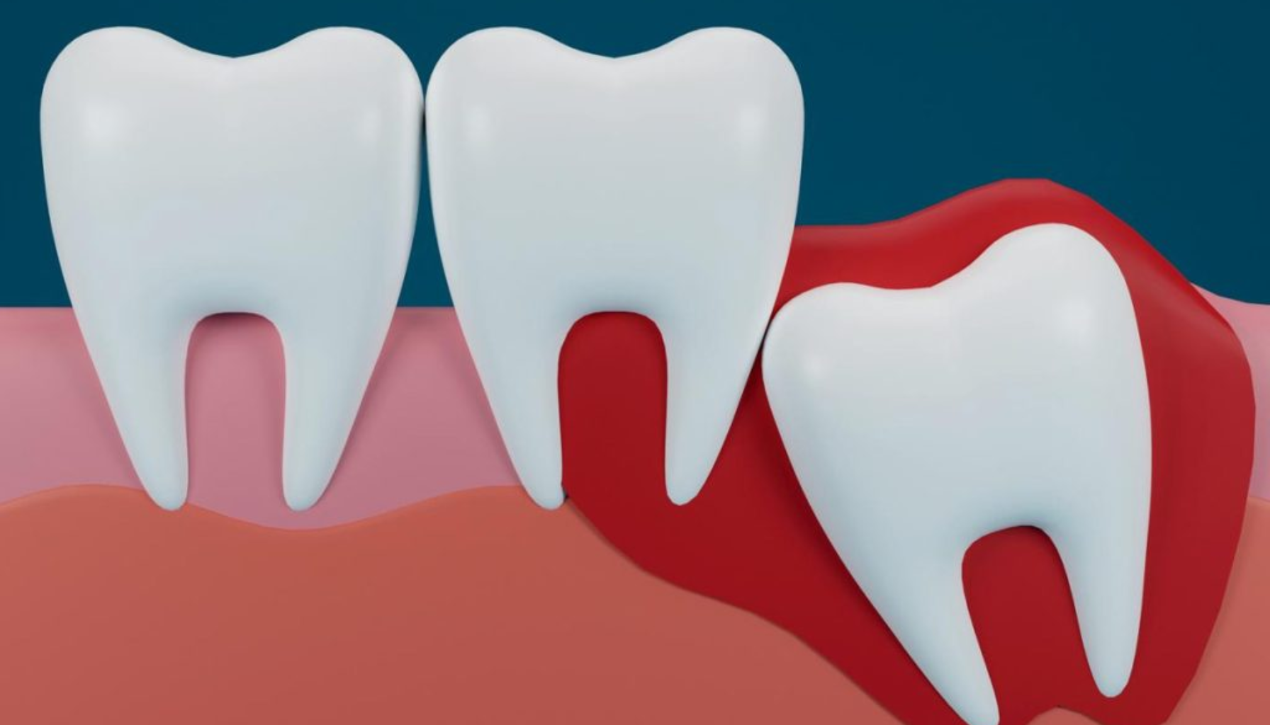 Visdomstenner: Symptomer, Behandling Og Når Du Bør Trekke