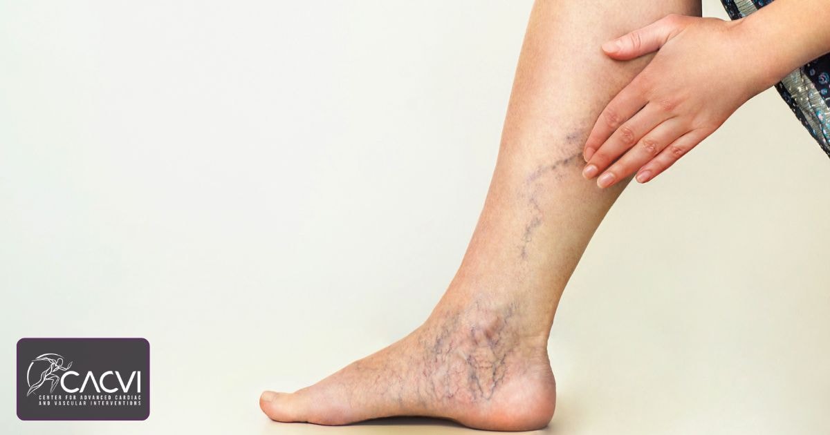 Can Varicose Veins Cause Foot Pain? Symptoms and Relief