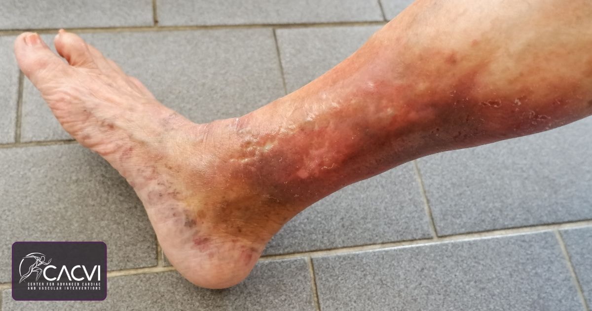 How to Identify 4 Different Foot Ulcer Stages?