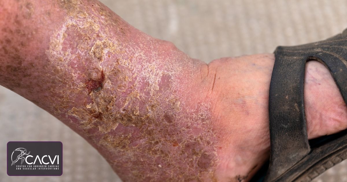 Leg Ulcer Pictures (2025) | CACVI