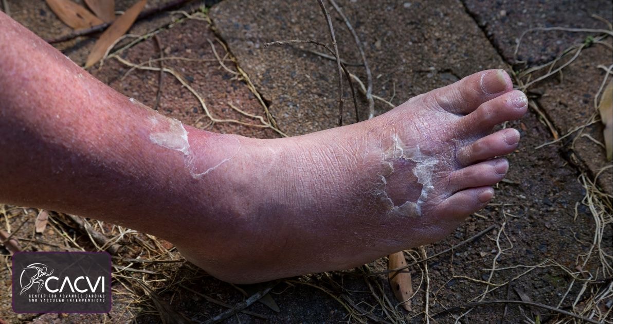 How to Identify 4 Different Foot Ulcer Stages?