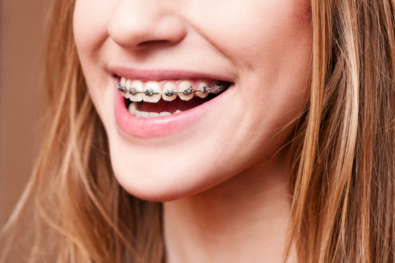 When Were Braces Invented? Amazing Orthodontic History